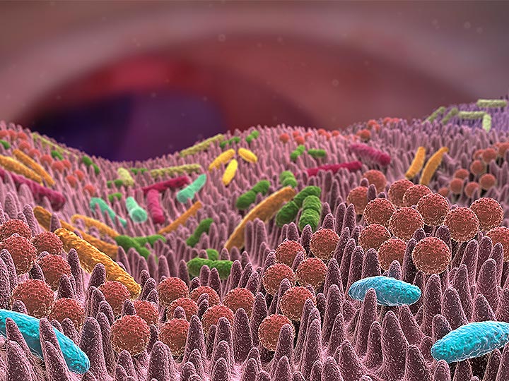 Rectocolite hémorragique (RCH)